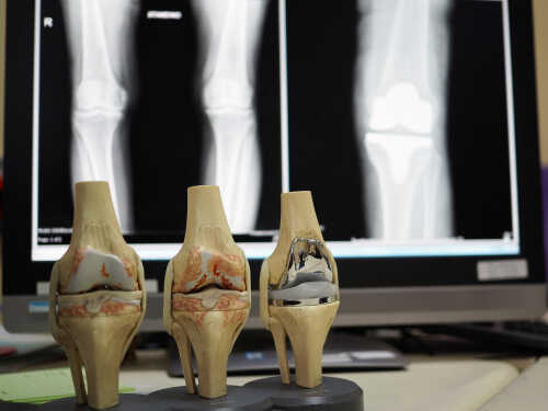 Cartilage Loss Reversed Without Surgery | Presidential Daily